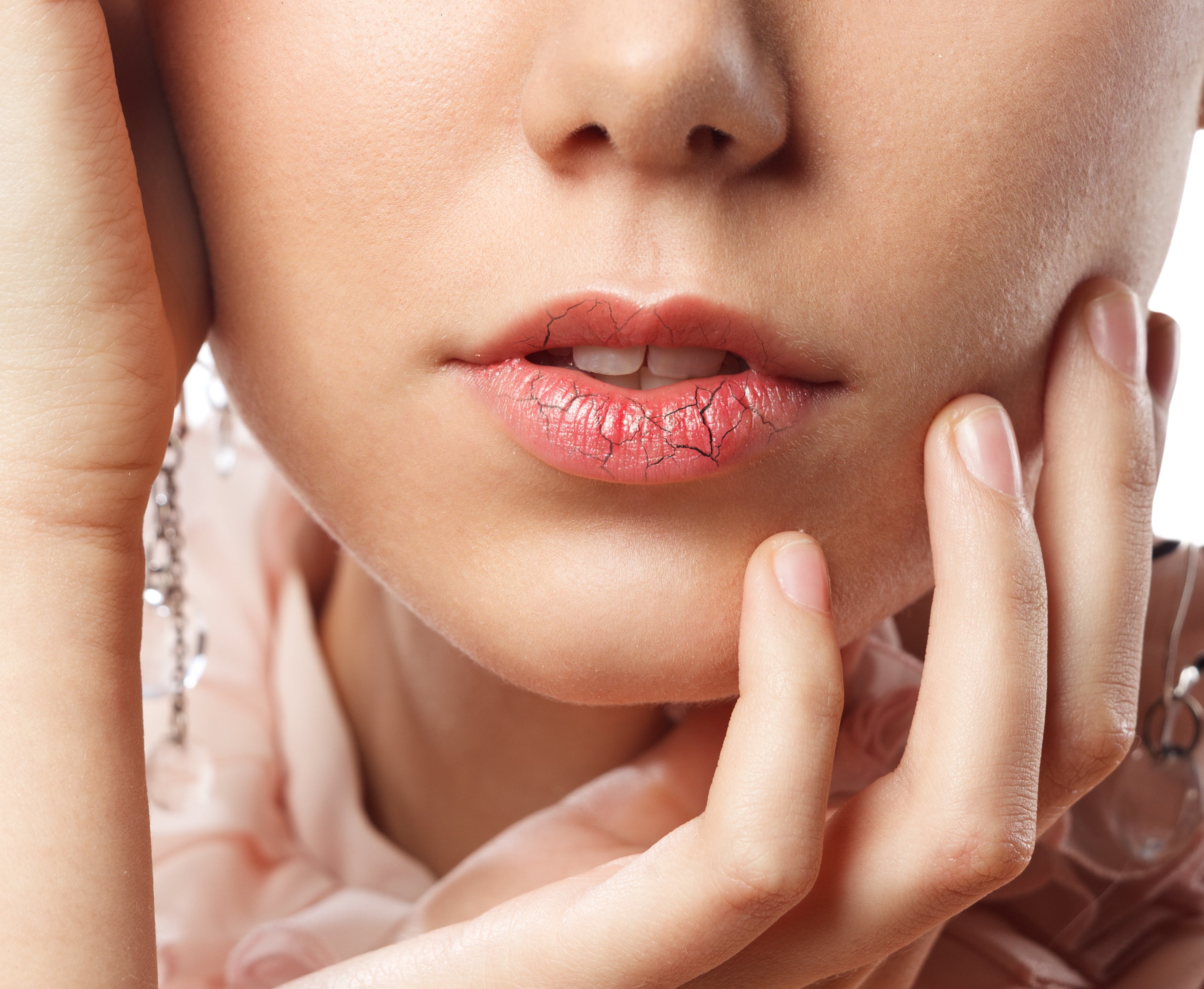 How to Heal Cracked Lips – Chapstick SBC
